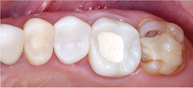 glidewell.io™ | Restorative Materials for Every Indication